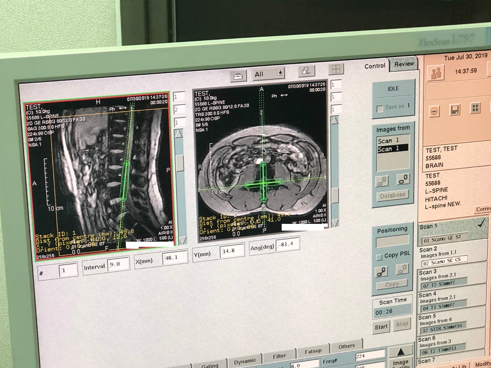 Second Hand Hitachi Medical Systems AIRIS II 0.3T MRI Scan