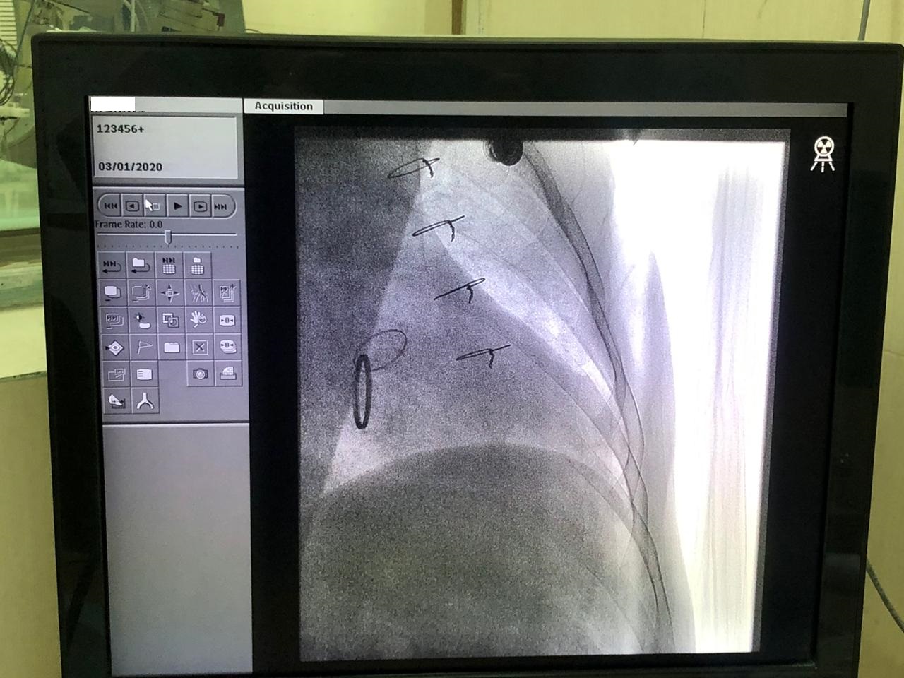 Used Philips Allura Xper FD 20 Cath Lab for Sale | 20Med